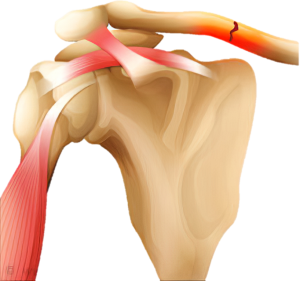 Fractured Collar Bone - Rehab On The Road
