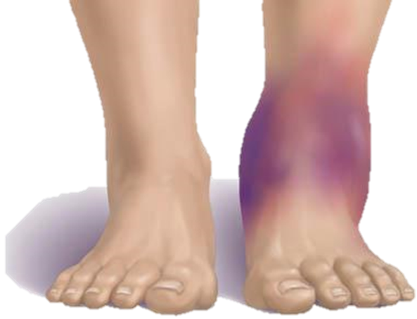 High Ankle Sprain - Rehab On The Road