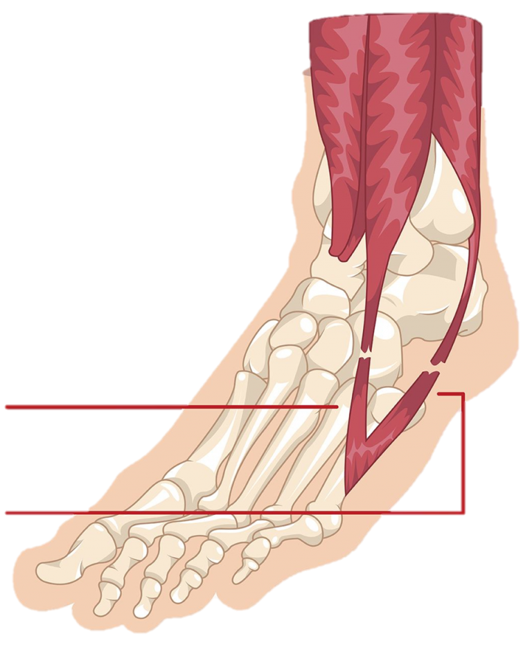 Ankle Strain - Rehab On The Road